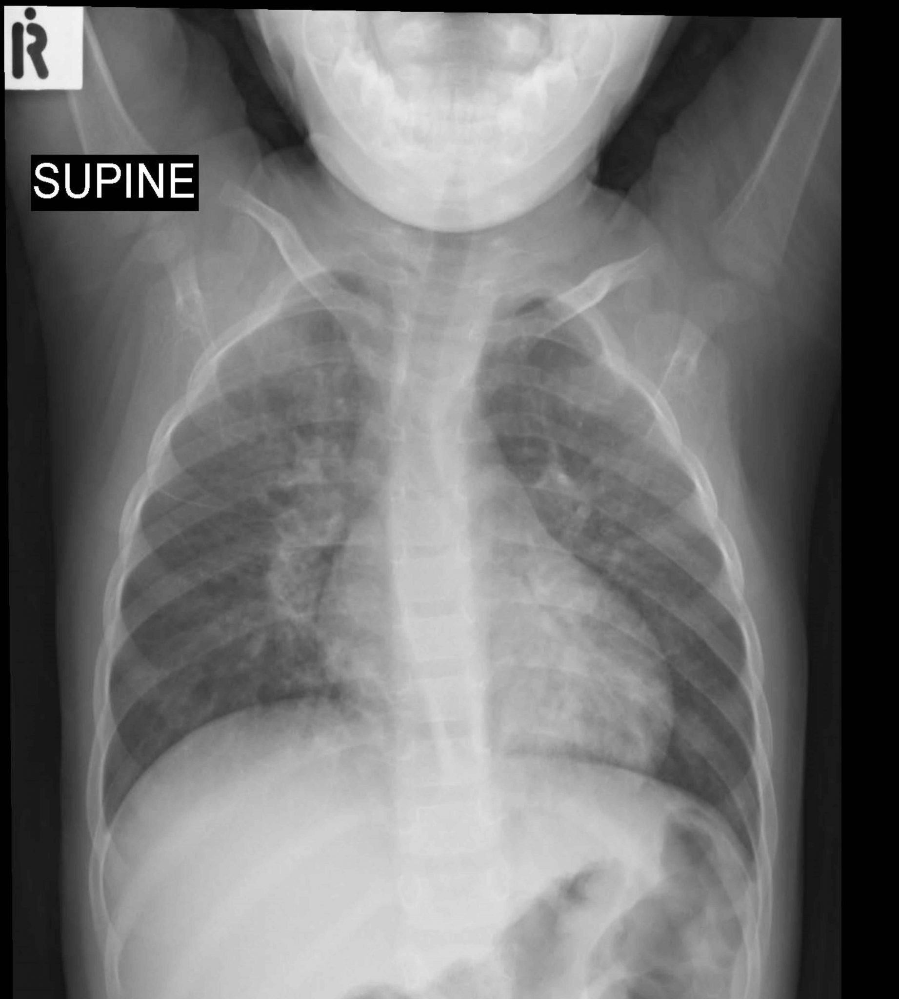 » Uncomplicated lymph node disease | The Union