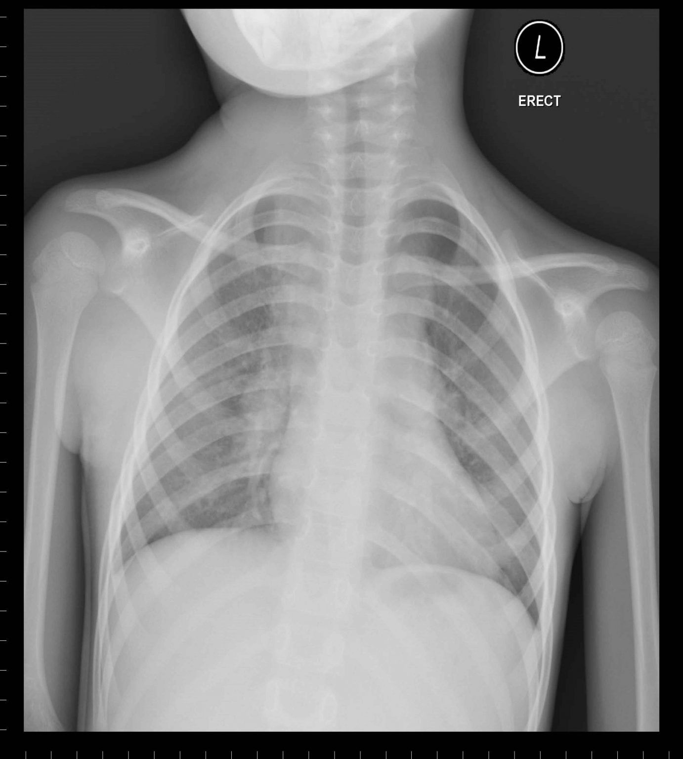 » Uncomplicated lymph node disease | The Union