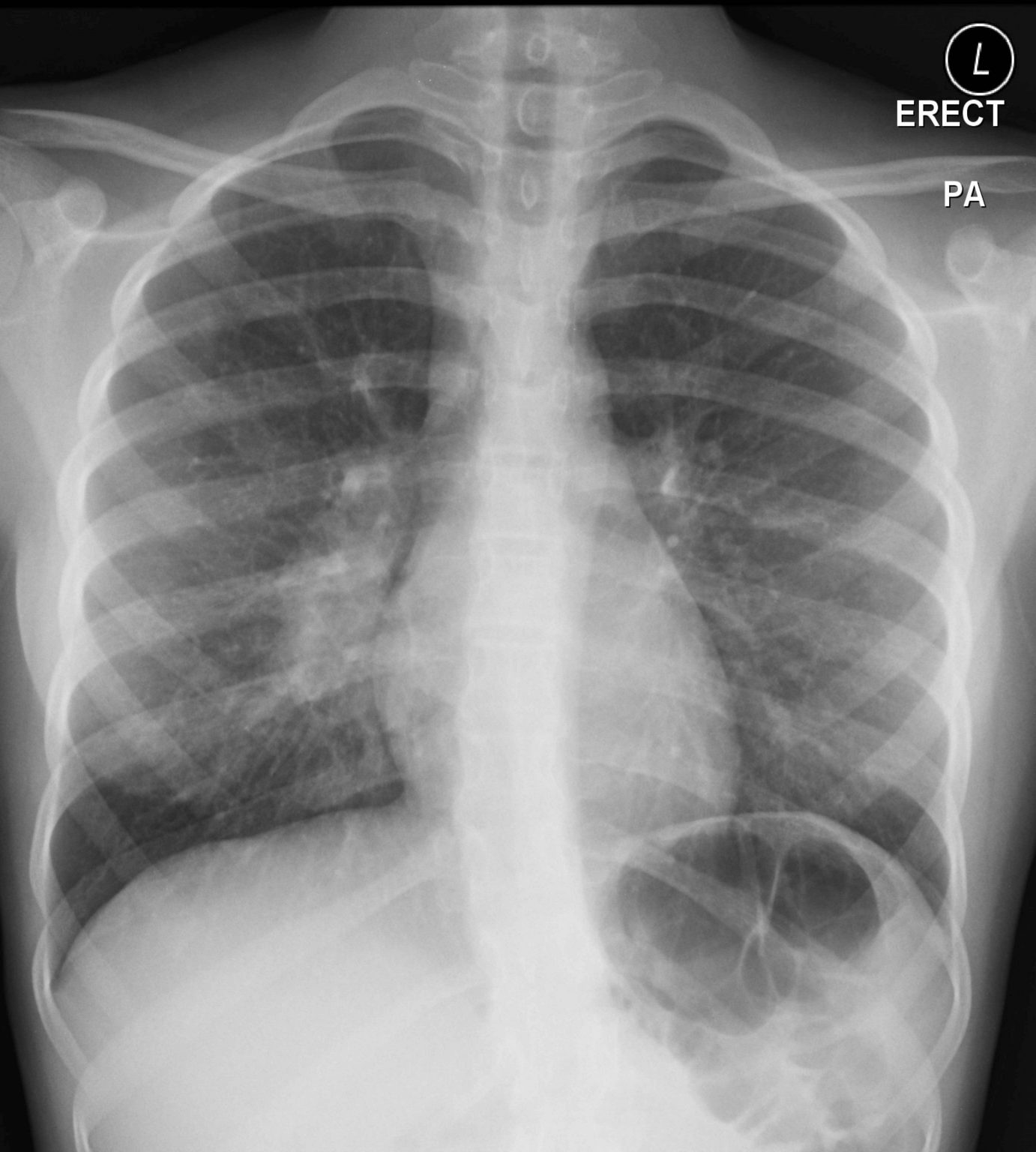 Uncomplicated lymph node disease - The Union