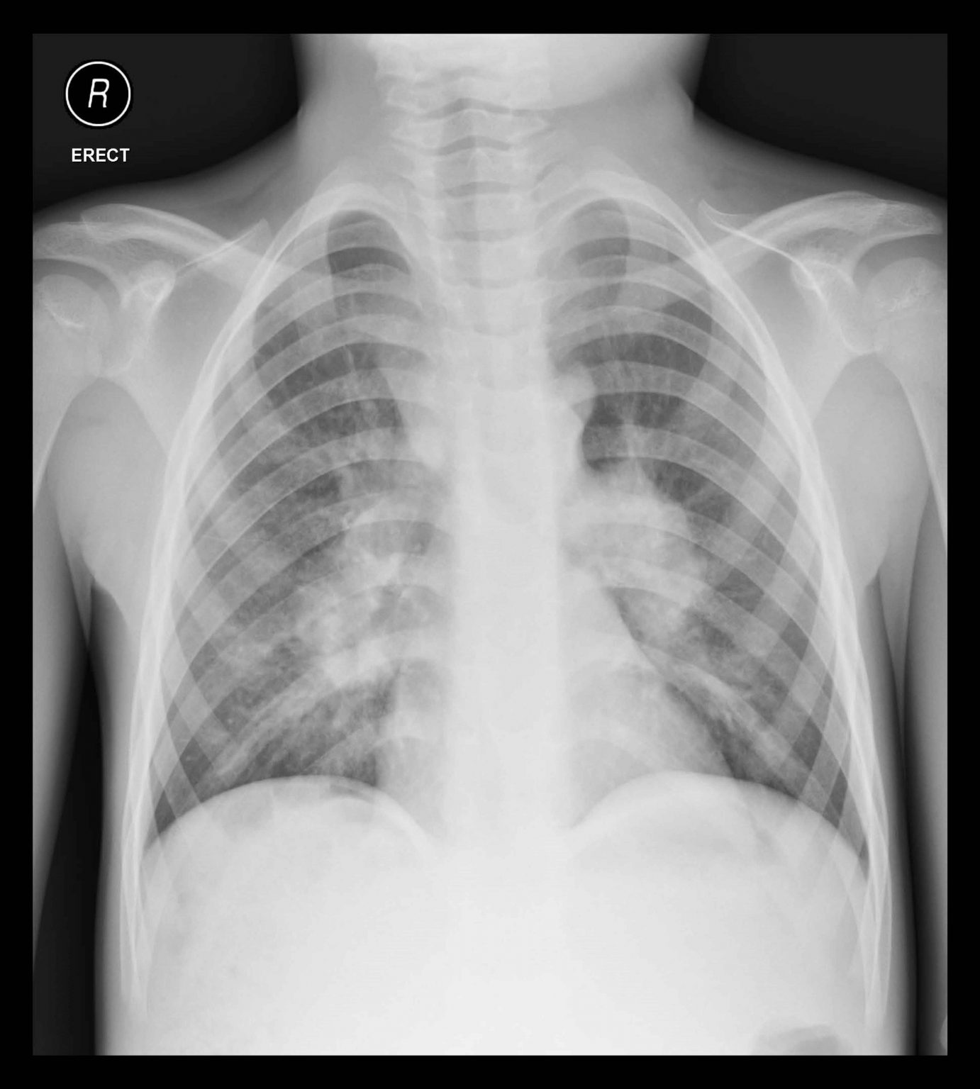 Uncomplicated lymph node disease - The Union