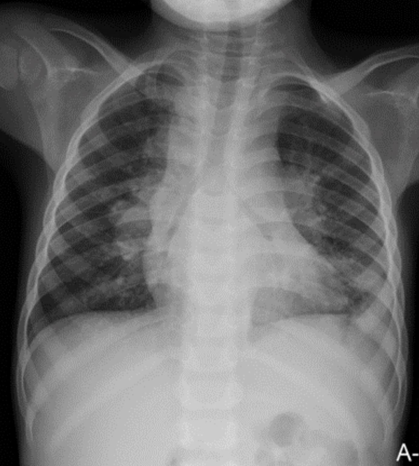 Uncomplicated lymph node disease - The Union