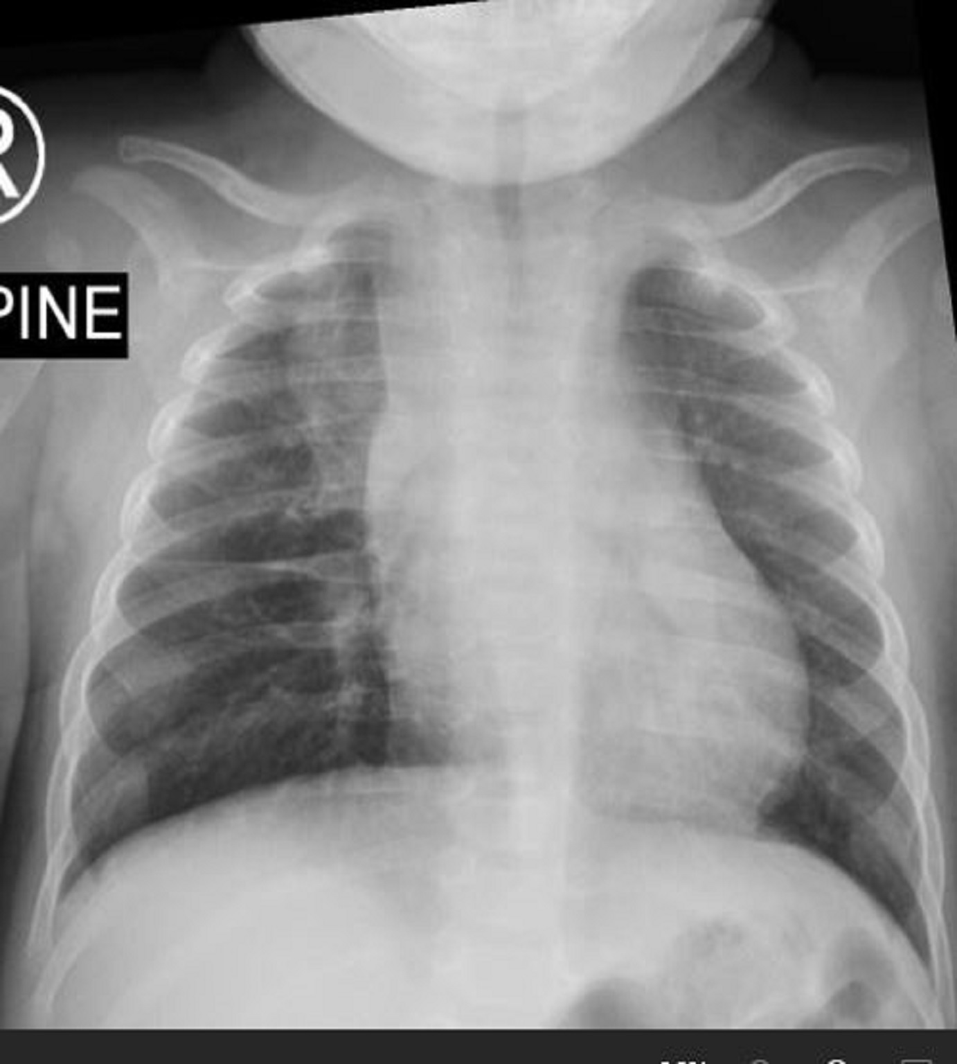 Complicated lymph node disease - The Union